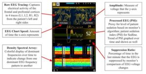 Neuromonitoring and Anesthesia: Why is it important to understand your ...