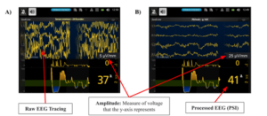 Neuromonitoring and Anesthesia: Why is it important to understand your ...